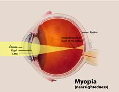 Shortsightedness (Myopia) - Symptoms and treatments for ...